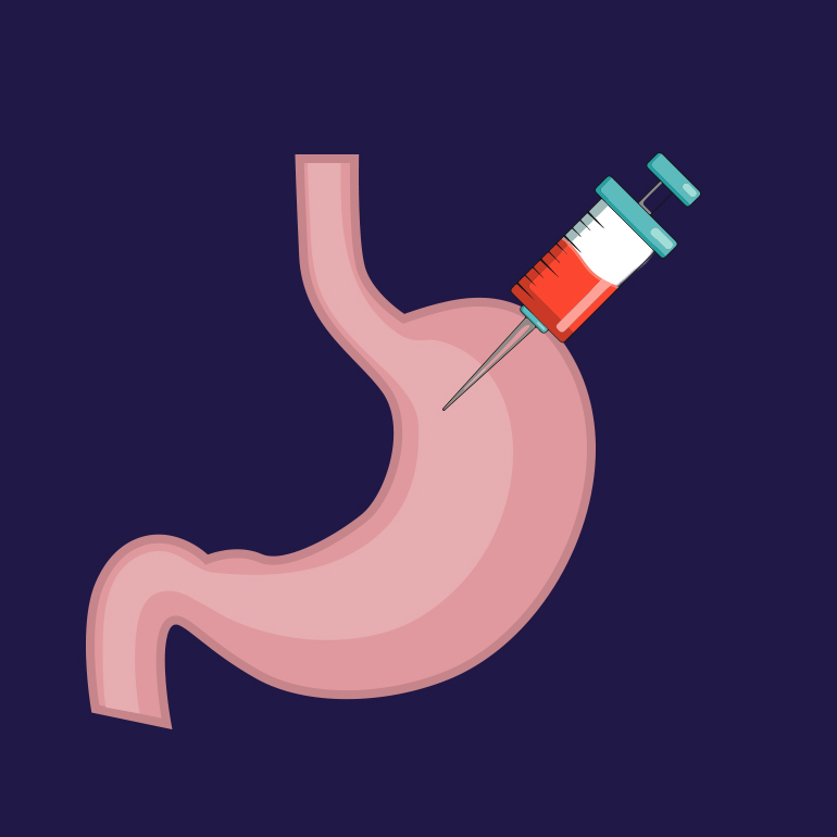 Gastric Botox - Dream International Hospital